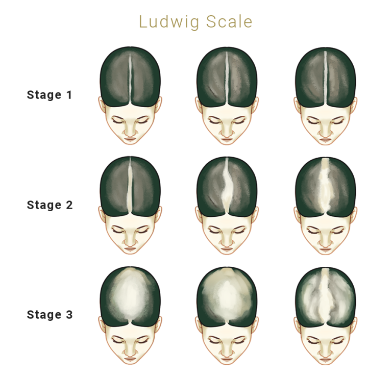 Female Hairloss - Sage Medical