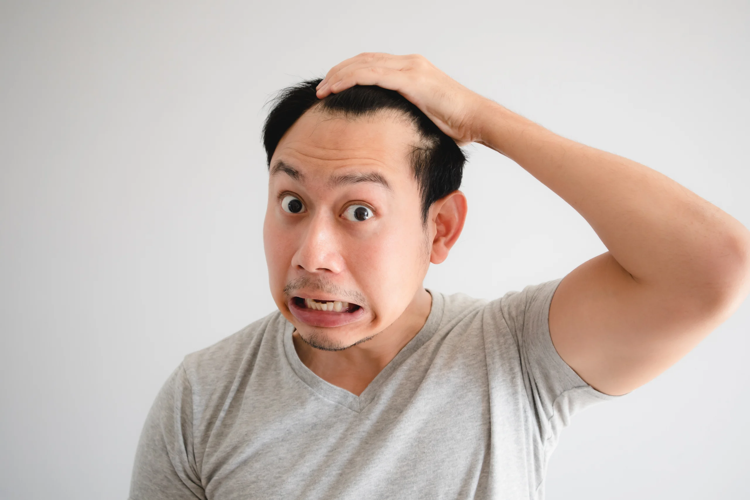 Navigating the 7 Stages of Baldness: A Comprehensive Guide - Sage Medical